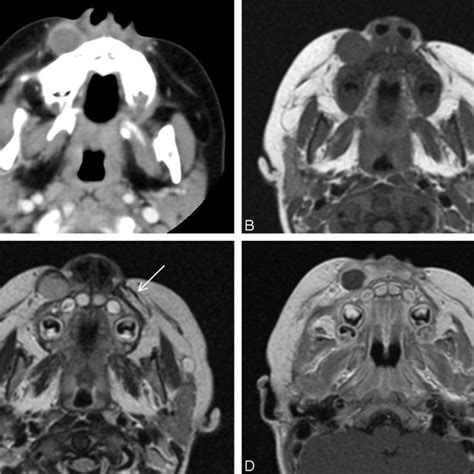 Case 5 Nodular Fasciitis In The Left Supraclavicular Fossa In An