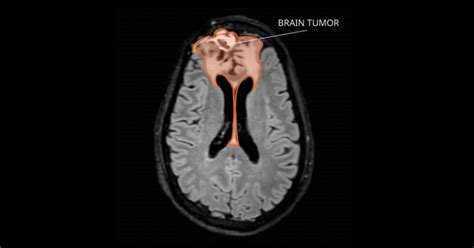 Oligodendroglioma National Cancer Institute