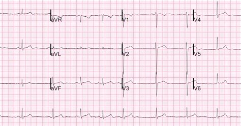 Wandering Atrial Pacemaker Ecg Wandering Atrial Pacemaker Findings
