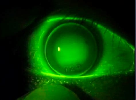 Fluorescein Patterns Flashcards Quizlet