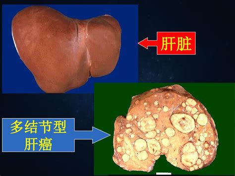 第五节 原发性肝癌 word文档在线阅读与下载 无忧文档