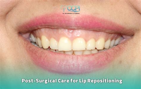 Post Surgical Care For Lip Repositioning Nooshin Ghayoumi Dds