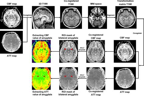 Post Processing Diagram Of Cerebral Perfusion By Multi Delay Asl Mr