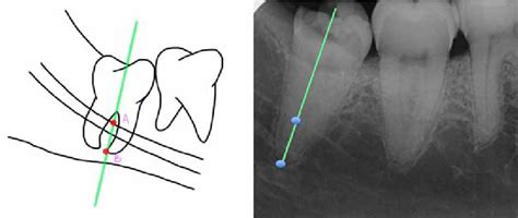 A Calculation Of The Root Migration Through The Distance Between