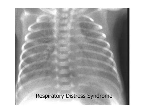 PPT THE TERM NEONATE WITH RESPIRATORY DISTRESS PowerPoint Presentation ID