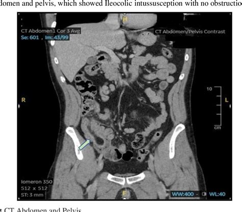 Figure 6 From Inverted Meckels Diverticulum A Case Report And Role Of Radiological Imaging