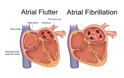 Atrial Fibrillation And Flutter IRAN Health Tourism Organizer Iran