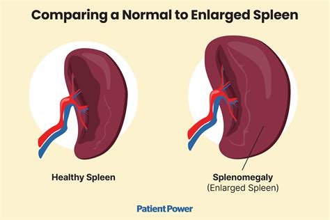 What Is Spleen Cancer Causes Symptoms Diagnosis And More Chiid Health