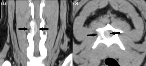 Example Of Extradural Compressive Lesion At C3 Multiplanar Soft‐tissue Download Scientific