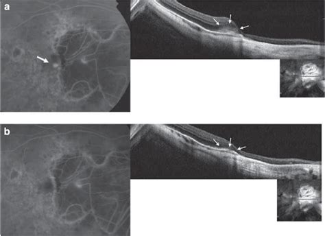 A A Recent Onset Cnv At The Edge Of The Myopic Peripapillary Crescent