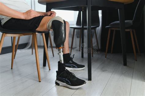 Man Amputee With Prosthetic Leg Disability On Above Knee Transfemoral