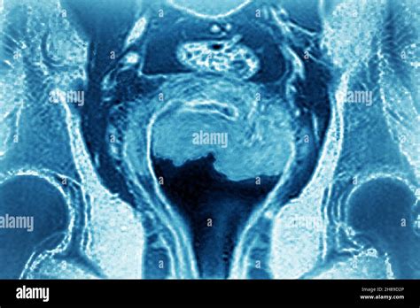Cáncer De útero Fotografía De Stock Alamy