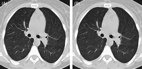 Lung Computed Tomography Images A Source Lung Image And B Median Download Scientific