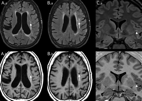 Frontal Lobe Small Vessel Disease