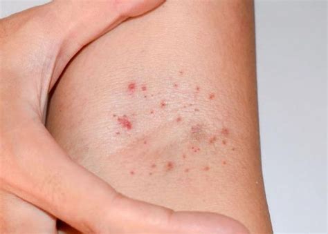 هن 5 أسباب لظهور البقع الحمراء على الجسم احذر المضاعفات