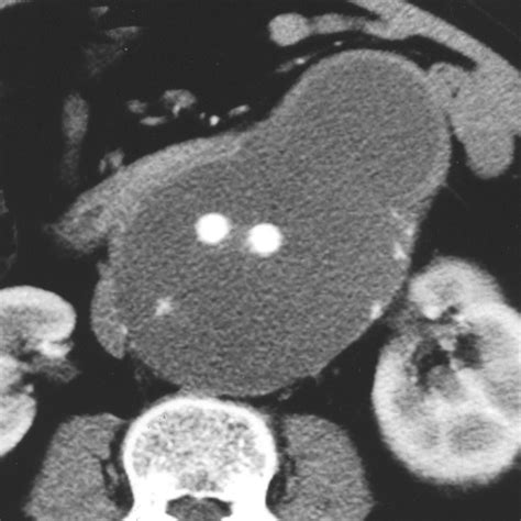 Perigraft Seroma Of Open Aortic Reconstruction Ajr