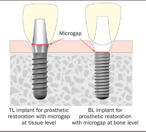 Overview Of Implant Morphology And Structure