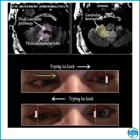Patient Presents With Diplopia Vertigo And Incoordination Exam Reveals Profound Horizontal