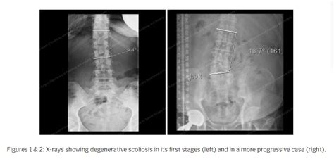 Is Degenerative Scoliosis A Disability Assessing Whether Degenerative