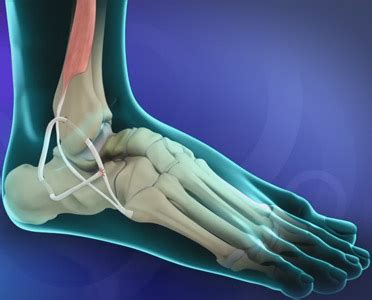 Lateral Ankle Ligament Reconstruction Baltimore Towson Ankle Sprain