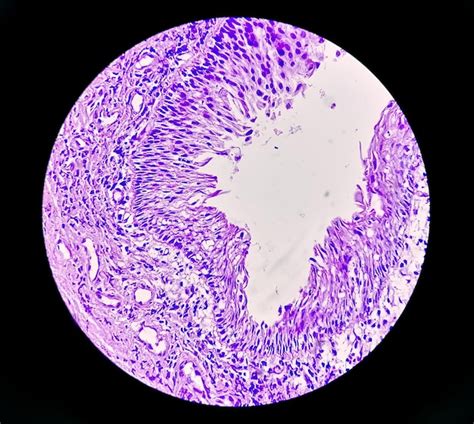 Histologie Du Kyste De Louraque Photomicrographie De La Lame Colorée