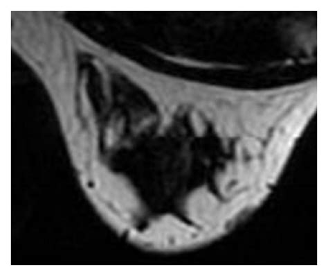 breast image preprocessing a original image b after preprocessing