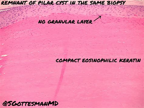 Pilar Cyst Histology