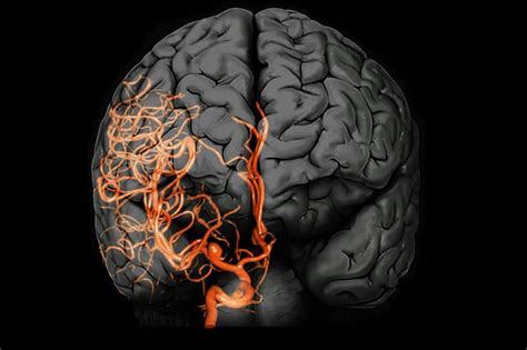 Brain Aneurysm 9 Unusual Symptoms Of This Condition That Can Lead To