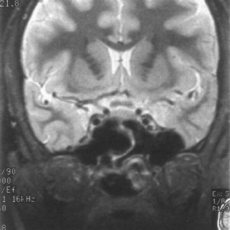 Photomicrograph Of Sinus Contents Allergic Mucin Composed Of Dense