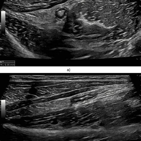 Ultrasound Examination Showing An Appendix With A Diameter Of 6 7 Mm