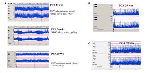 A Aeeg Findings Of Normal Background Activity In Relation To