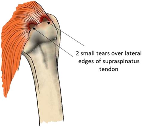 Human Dermal Allograft Patch Augmentation Of Degenerate Rotator Cuff