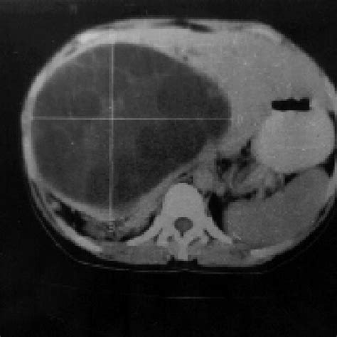 Hepatic Cyst