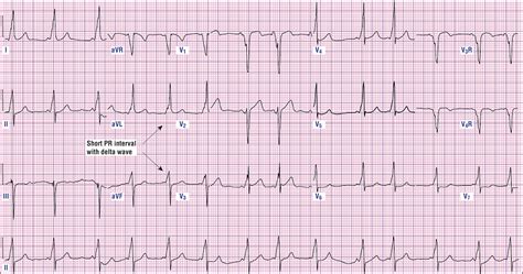 Ventricular Tachycardia