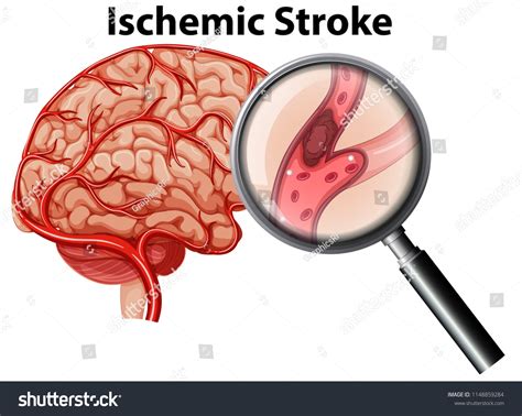 Ischemic Stroke Brain