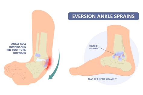Sprained Ankle Heal Time Understanding Different Grades Of Sprains