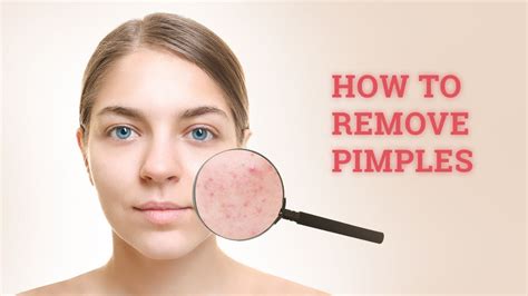 Pimple Remove Tips Remove Any Type Of Pimple At Home By These Method