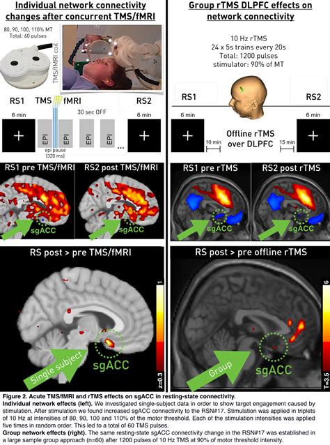 Concurrent Tmsfmri Demonstrates Direct Sgacc Target Engagement Neuroimaging