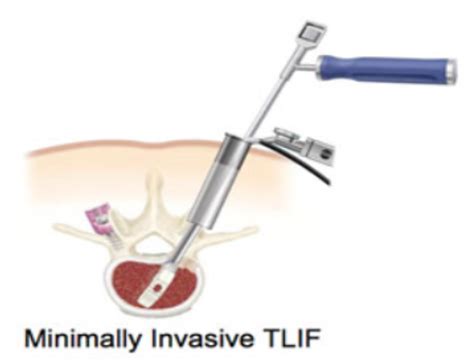 การผ่าตัดเชื่อมข้อกระดูกสันหลัง Mis Tlif แบบแผลเล็ก บาดเจ็บน้อย ฟื้น