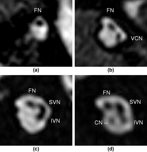 Imaging For Cochlear Implantation Structuring A Clinically Relevant Report Clinical Radiology
