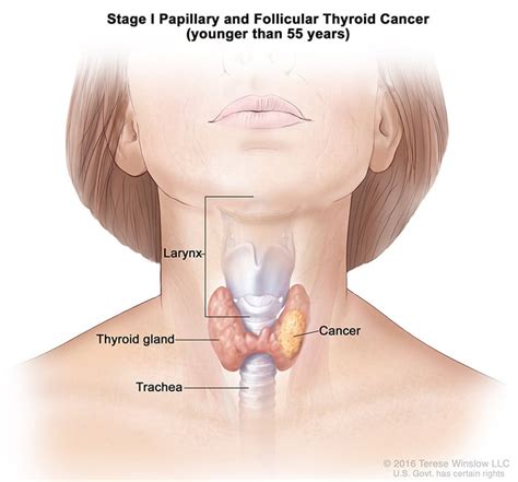 Thyroid Cancer Staging Rmcc