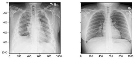 Ishan Biyani On Linkedin Cxr Images Classification