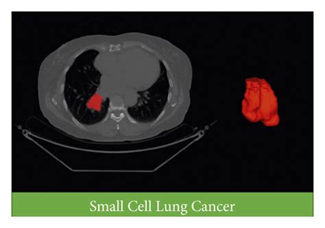 Segmentation Of Lesions On Ct Images And 3d Roi For A Adenocarcinoma