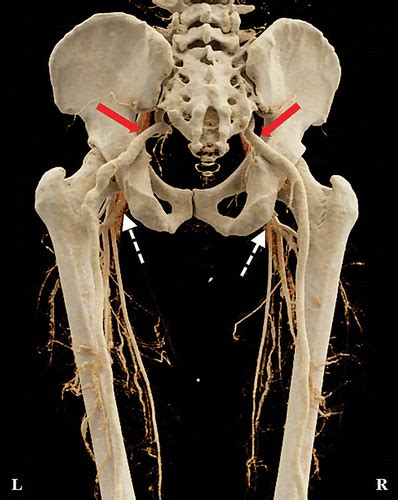 Bilateral Persistent Sciatic Arteries Radiology