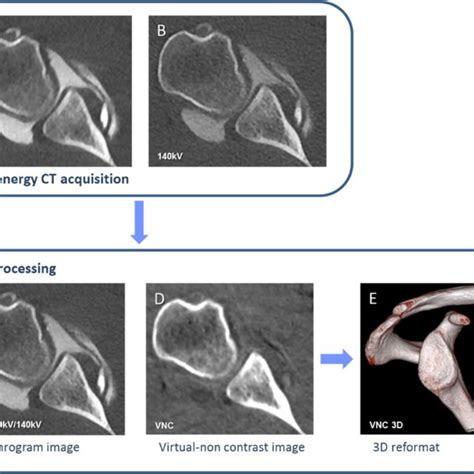 Image Acquisition And Workflow Of Dual Energy Ct After Arthrography Of Download Scientific