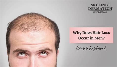 Why Does Hair Loss Occur In Men Causes Explained Clinic Dermatech