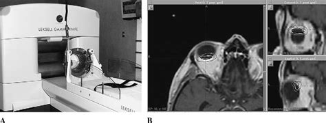A Gamma Knife Unit With Collimator Helmet B Gamma Knife Plan For