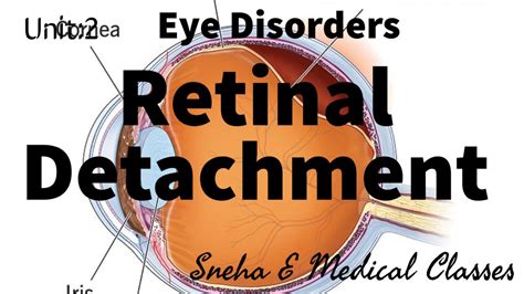 Retinal Detachment Cause Sign And Symptoms Pathophysiology