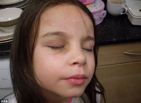 Ellie Butler Suffered Two Previous Skull Fractures Before She Died Daily Mail Online