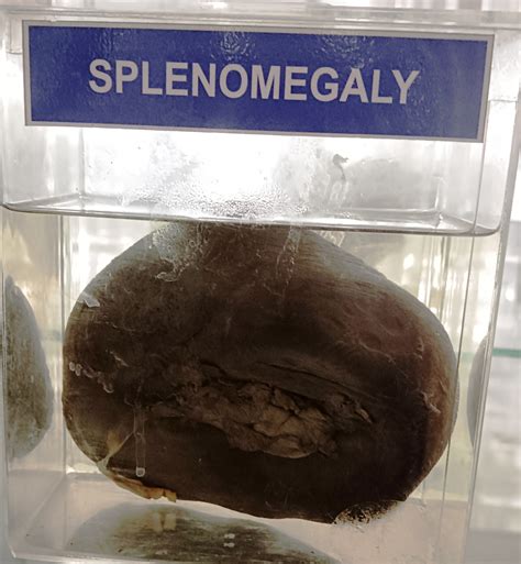 6 Splenomegaly Namo Medical Education And Research Institute